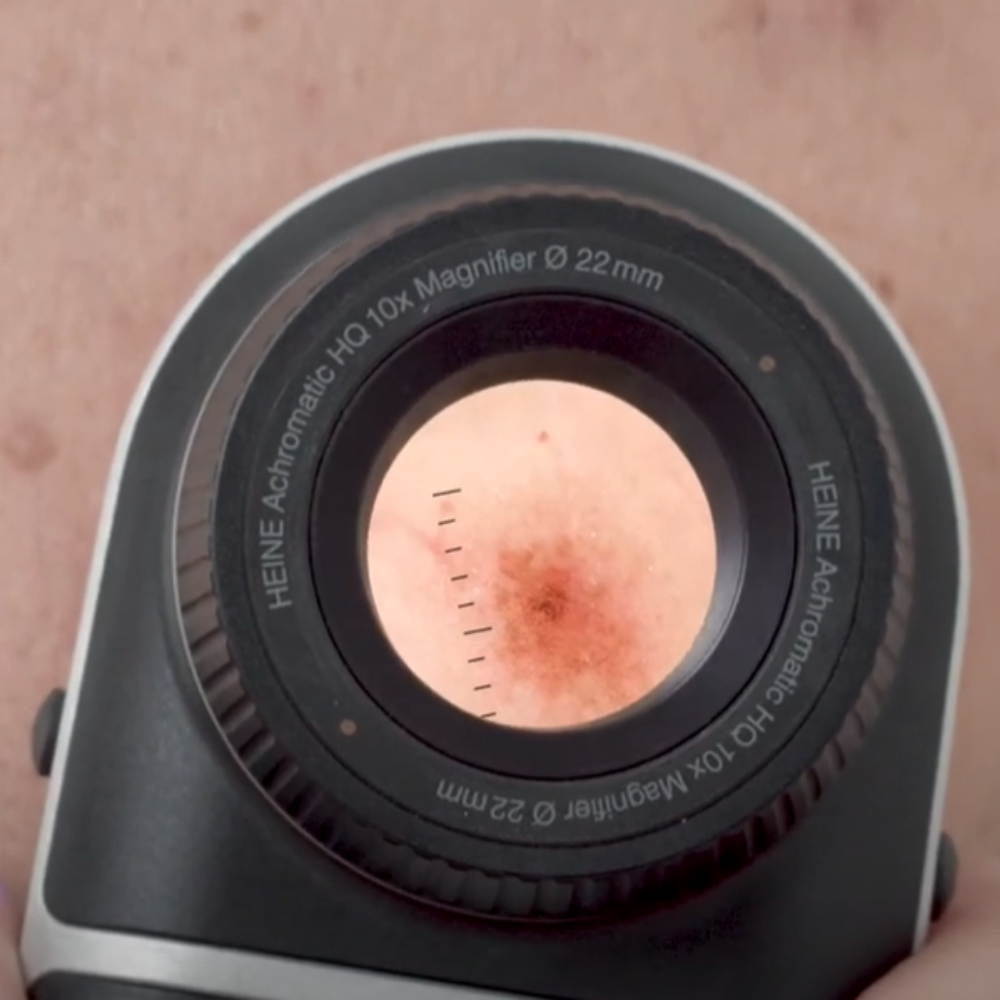 Tout savoir sur le dermatoscope Heine DeltaOne | Girodmedical Blog