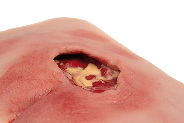 Modèle de plaie décubitus sacré nettoyé Erler Zimmer