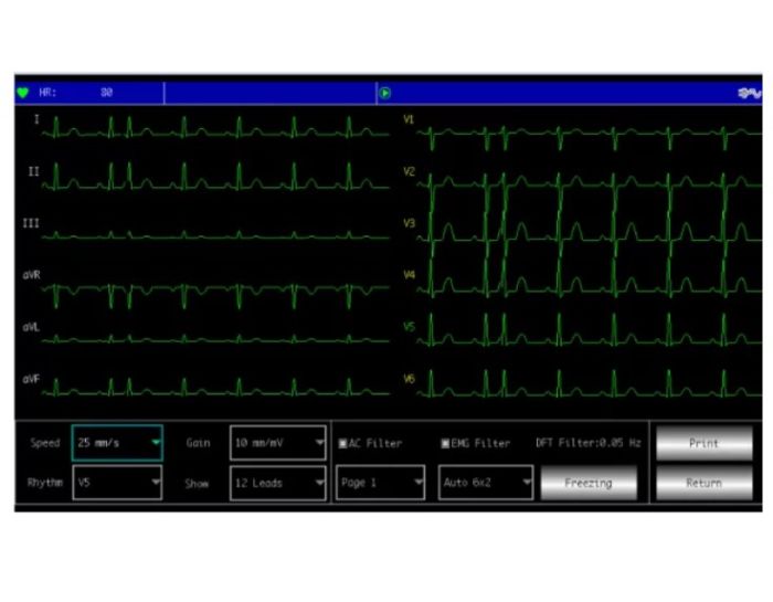 Electrocardiographe ECG Contec 600G 6 pistes avec interprétation