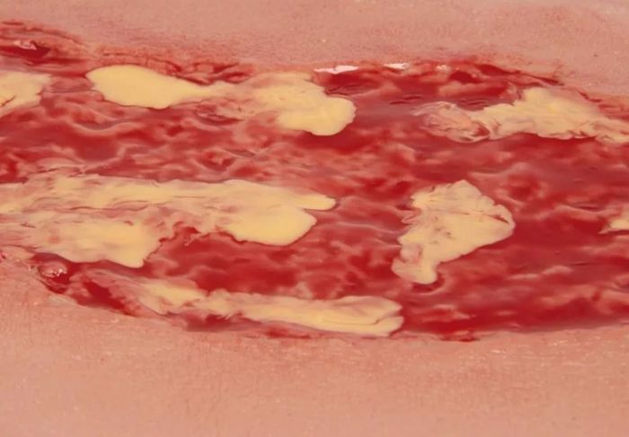 Modèle d'un ulcère veineux de la jambe en phase d'exsudation