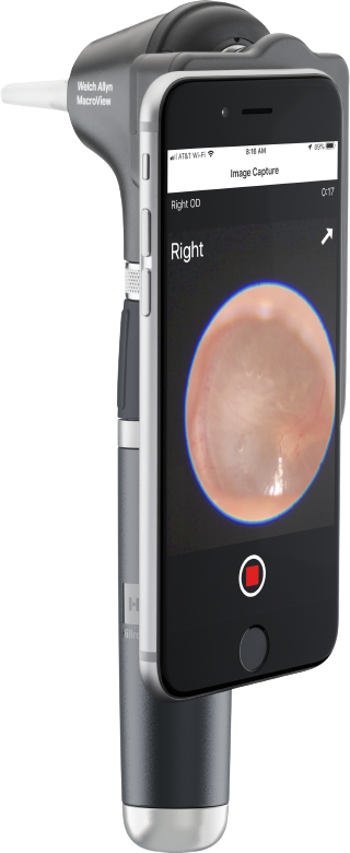 Otoscope LED Macroview 2 Plus iExaminer Welch Allyn