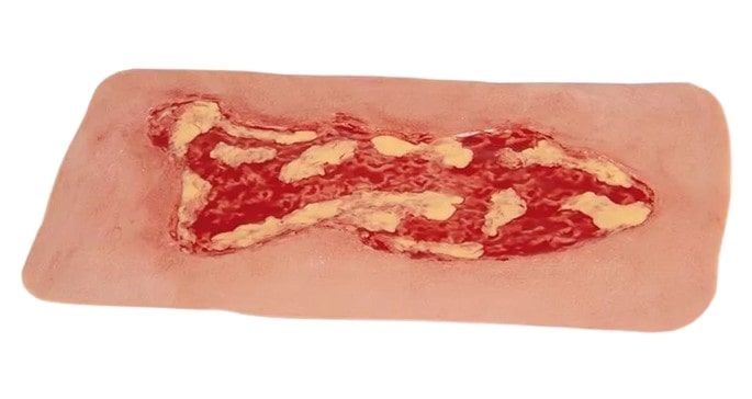 Modèle d'un ulcère veineux de la jambe en phase d'exsudation